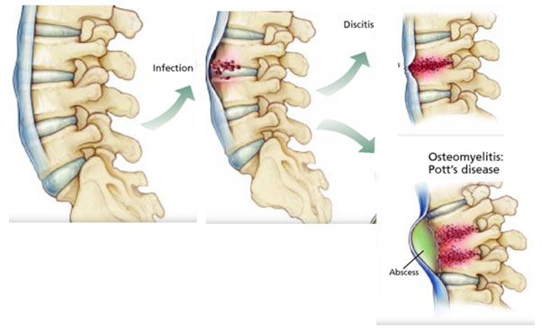 Spinal Tuberculosis ( Potts Spine ) - dr jyotheswara reddy